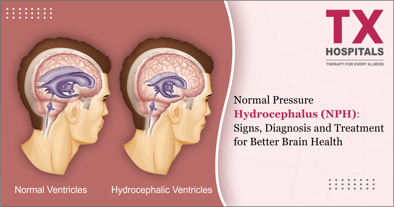 Normal Pressure Hydrocephalus (NPH): Signs, Diagnosis and Treatment for ...